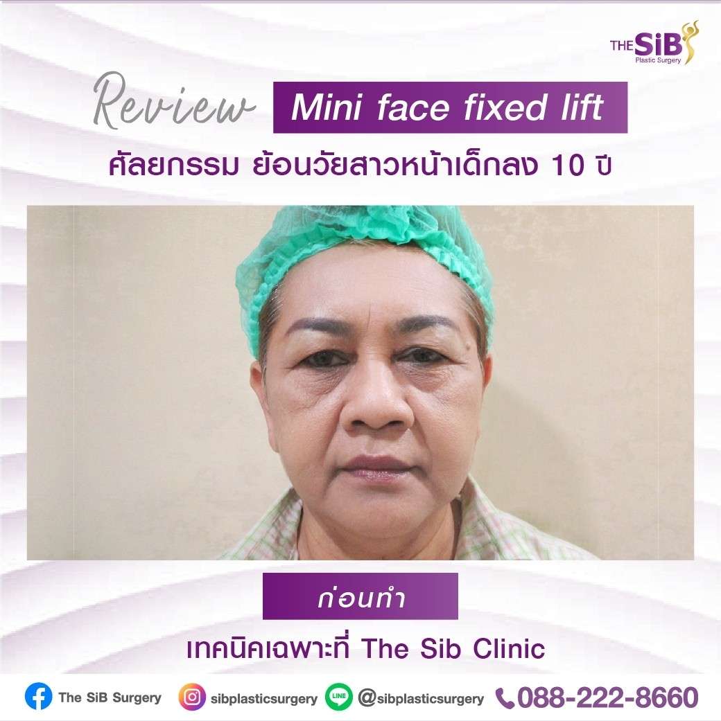 ย้อนวัยสาว mini Face Fixed lift - The Sib Plastic Surgery คลินิก ...