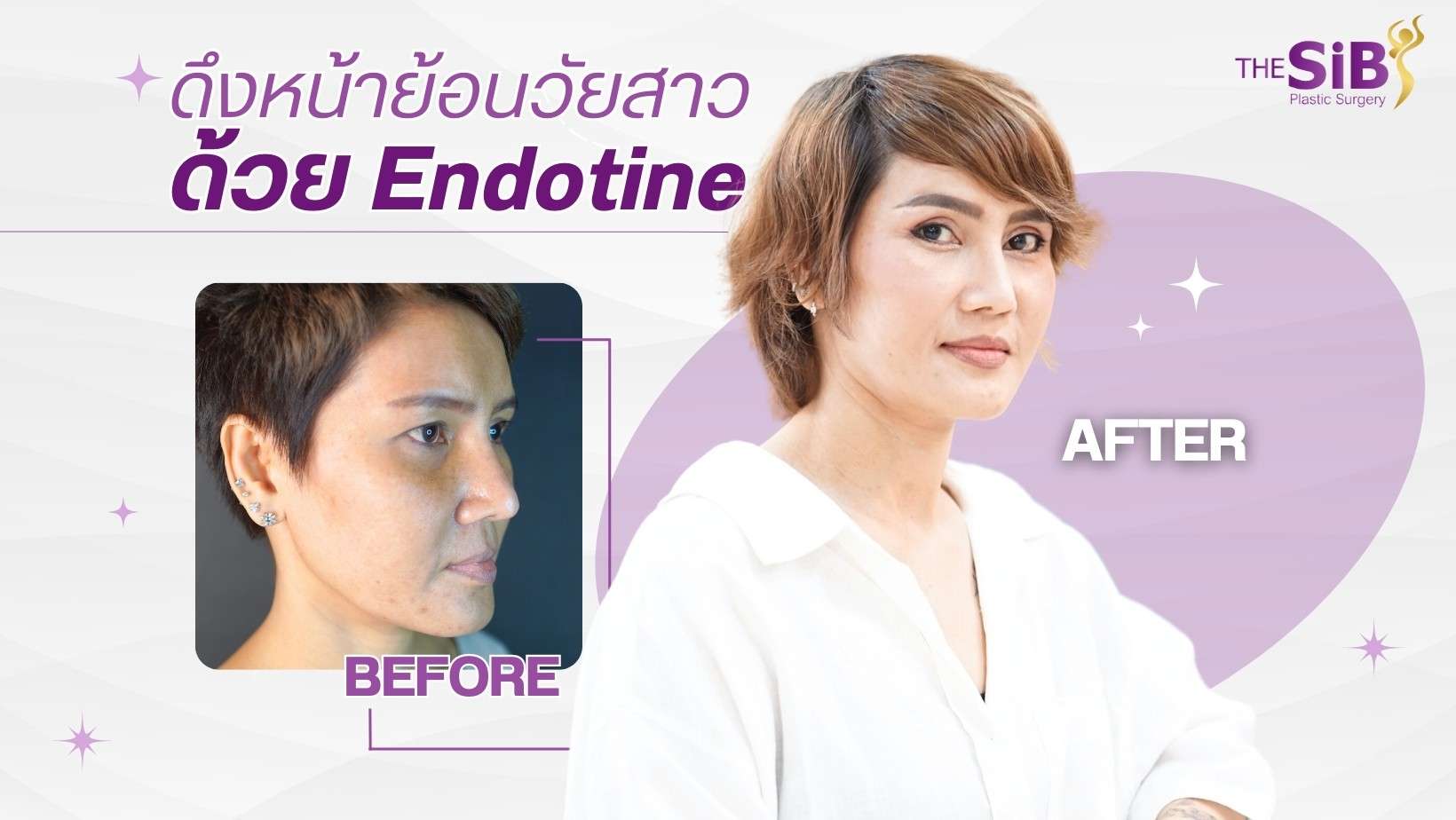 Endotine Face Lift ดึงหน้าไม่ต้องผ่าตัด เทคนิค ปี 2025