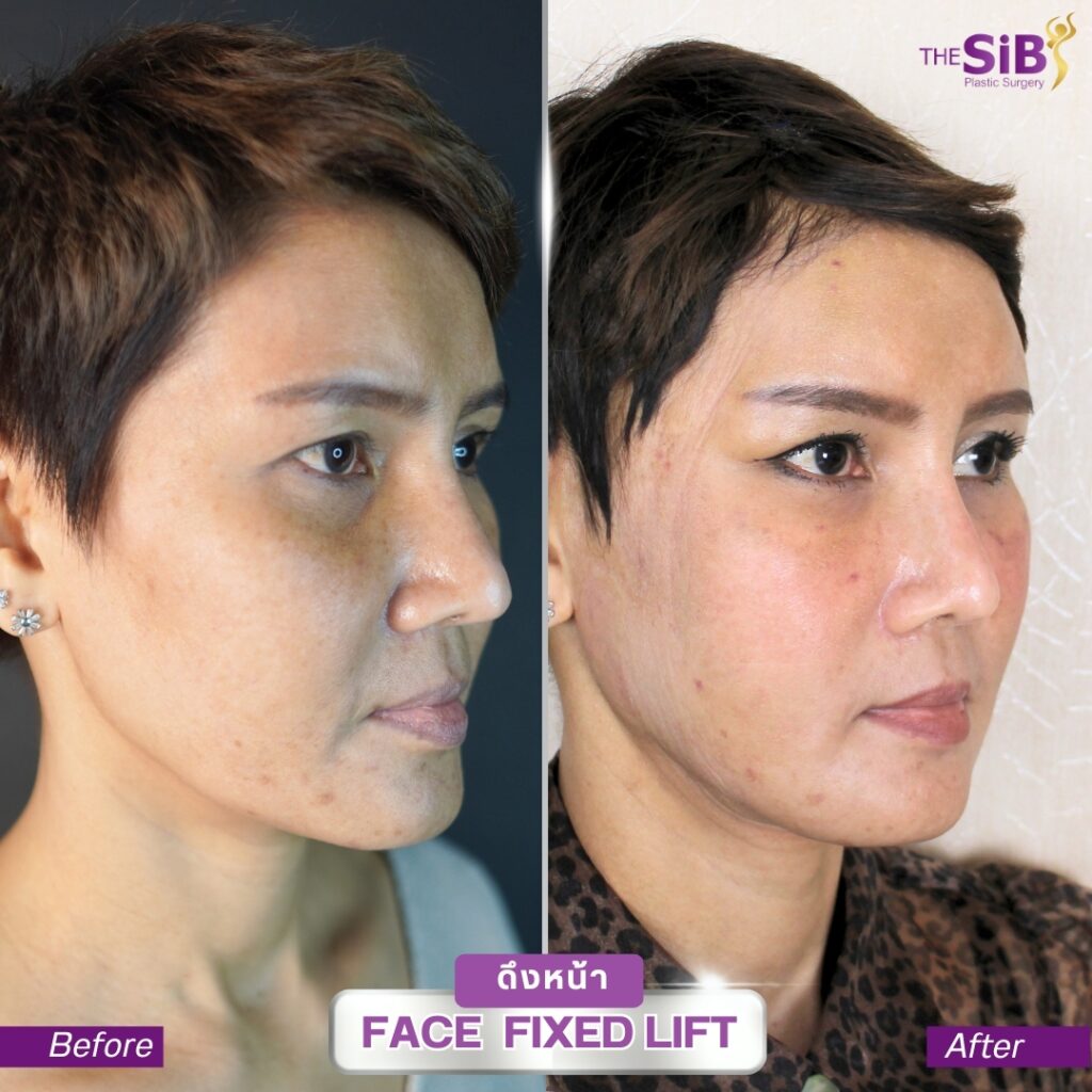 Endotine Face Lift ดึงหน้าไม่ต้องผ่าตัด เทคนิค ปี 2025